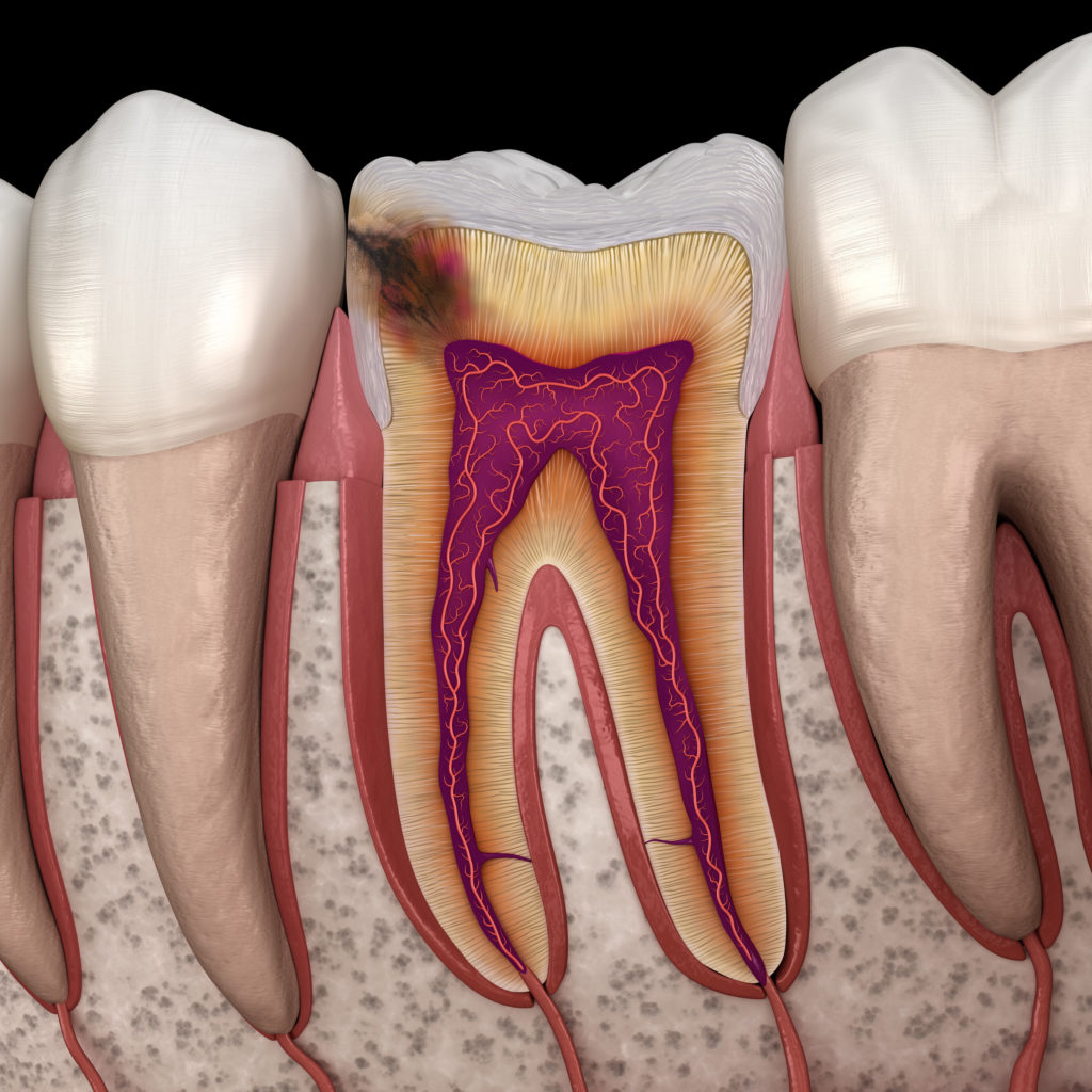 How Do You Know If You Have a Cavity Between Your Teeth?